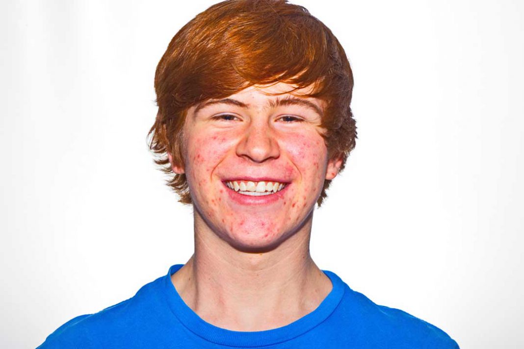 Teen Acne: Facts, Causes, Prevention, and Treatments | Consumer Health ...